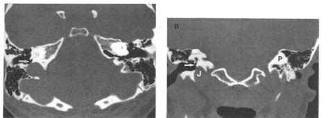 A Axial And B Coronal Ct Sections Showing Severe Labyrinthitis