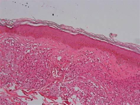 Leprosy An Update Definition Pathogenesis Classification Diagnosis And Treatment Actas