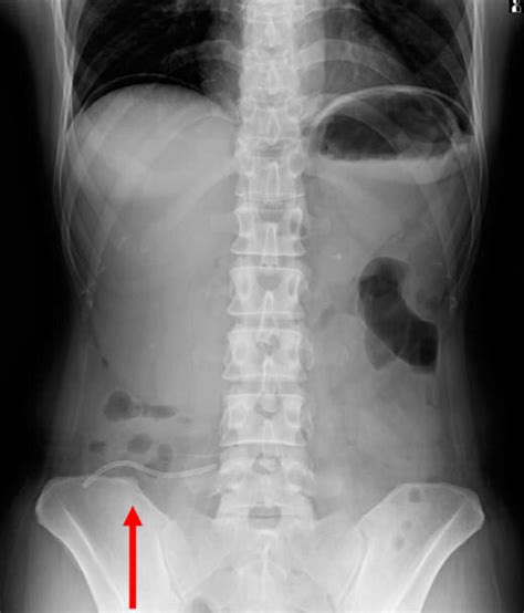 Abdominal X Ray Shows A Migrated Pancreatic Stent Arrow Download Scientific Diagram