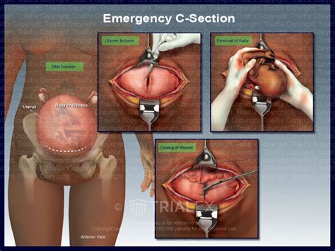 Emergency C Section Trialquest Inc