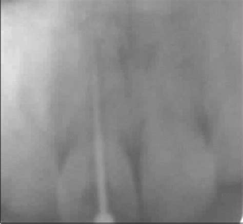 Radiographic Determination Of Working Length Download Scientific Diagram