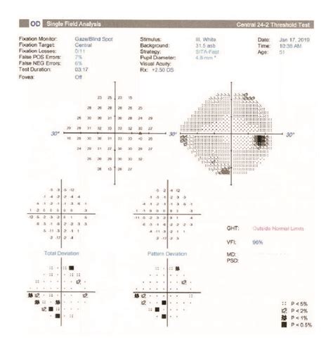 Humphrey Visual Field Of The Patient Of The Right Eye Shows Scattered