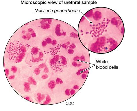 Neisseria Gonorrhoeae Microscope Meningococcus Seen Under A Scanning