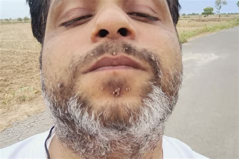 Ugly Cauliflower Warts Got Cured Homeo Energy
