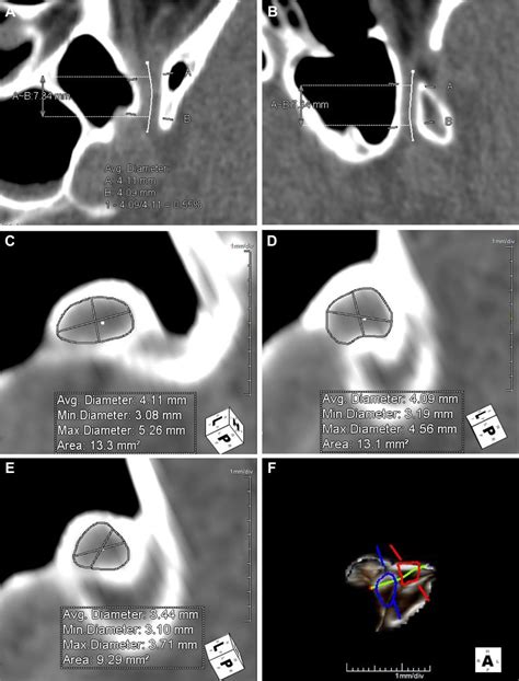 Optic Canal Contents