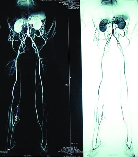 Magnetic Resonance Angiography Shows An Aao Magnetic Resonance