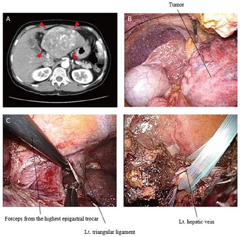 Totally Laparoscopic Hemi Hepatectomy Of Left Liver For Large Tumor Download Scientific