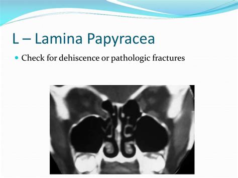 Ppt Principles Of Functional Endoscopic Sinus Surgery Powerpoint