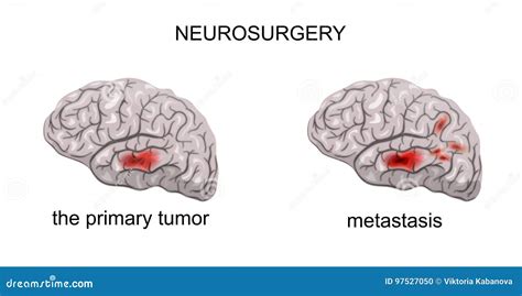 Brain Tumor Neurosurgery Stock Vector Illustration Of Head 97527050
