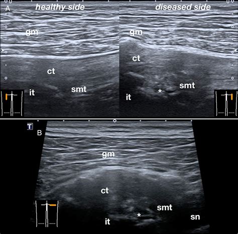Hamstring Ultrasound Protocol At Jenenge Blog