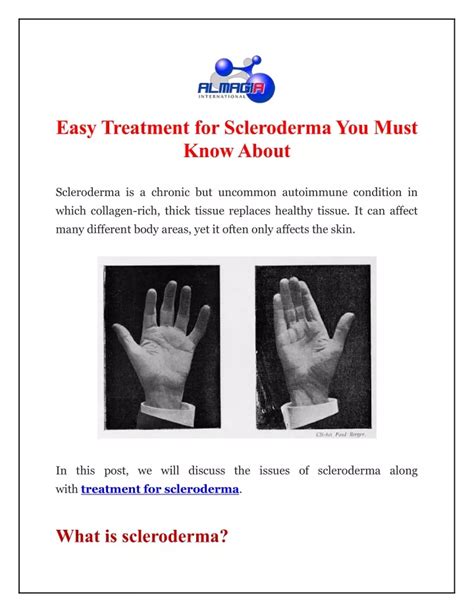 PPT Easy Treatment For Scleroderma You Must Know About PowerPoint Presentation ID