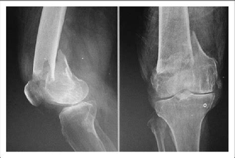 Preoperative Anteroposterior And Lateral X Rays Of Comminuted Fracture Download Scientific