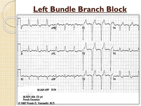 Ppt Bundle Branch Block Powerpoint Presentation Free Download Id 2363150