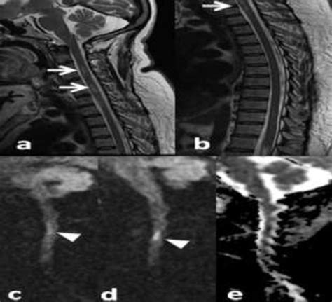 Covid 19 Related Temporal Lobe Encephalitis A 70 Year Old Female With