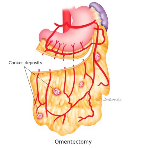 अर्ली ओवेरियन कैंसर Cancerclinix