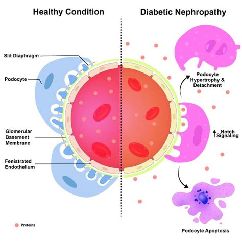 Comparative Illustration Of Podocytes During Health And Disease Dn