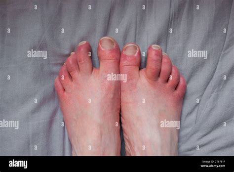 Feet Of Person With Erythromelalgia Erythromelalgia Symptoms Flare