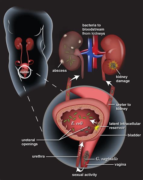 E Coli Treatment