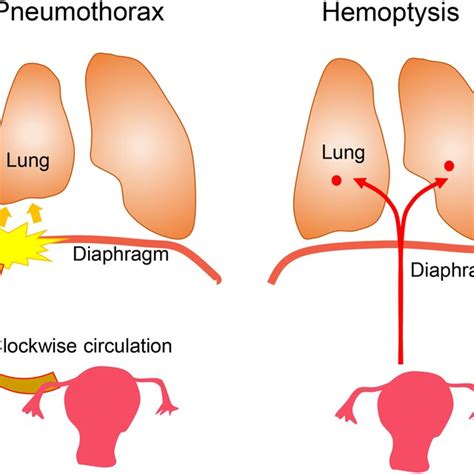 Hypothesized Pathogenesis Of Catamenial Pneumothorax Cp And