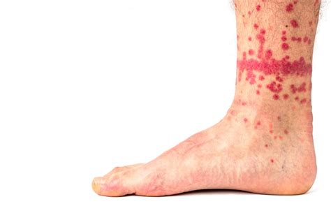 Fleabites Symptoms Causes Risks And Treatment