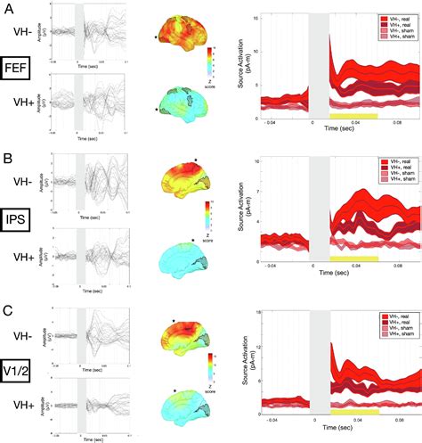 Figure 4 From Effective Connectivity Abnormalities In Lewy Body Disease With Visual