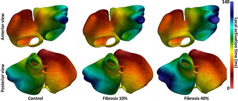 Anterior And Posterior View Of The Local Activation Time Map For Download Scientific Diagram