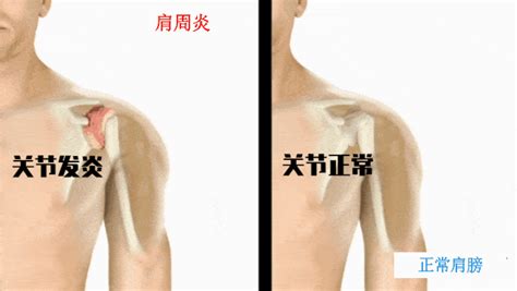 脖子疼、肩膀疼，很有可能不是颈椎病、肩周炎！而是它｜健康日历肌肉