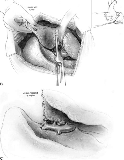 Lung Segmentectomy For Patients With Peripheral T1 Lesions Operative Techniques In Thoracic
