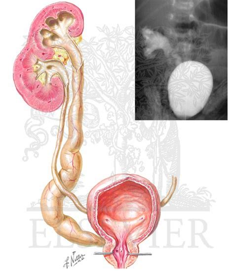 Ureteral Duplication Complete