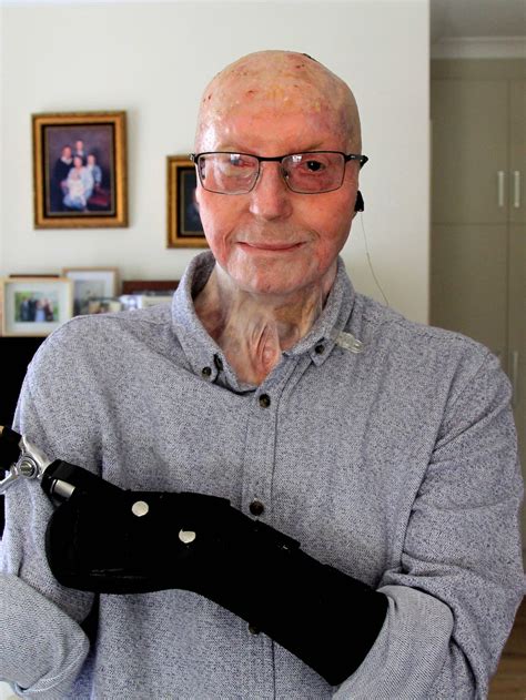 Terry Lost His Hands In A Bushfire — Heres Why Plastic Straws Would Make His Life Easier Sa