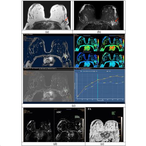 40 Year Old Female With History Of Left Breast Cancer Managed By Download Scientific Diagram