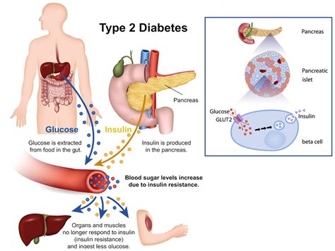 Diabetes Tipo 2 Insulina