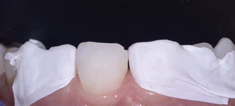 Flowable Injection Technique Kompozytowa Alternatywa Dla Licówek Porcelanowych Magazyn