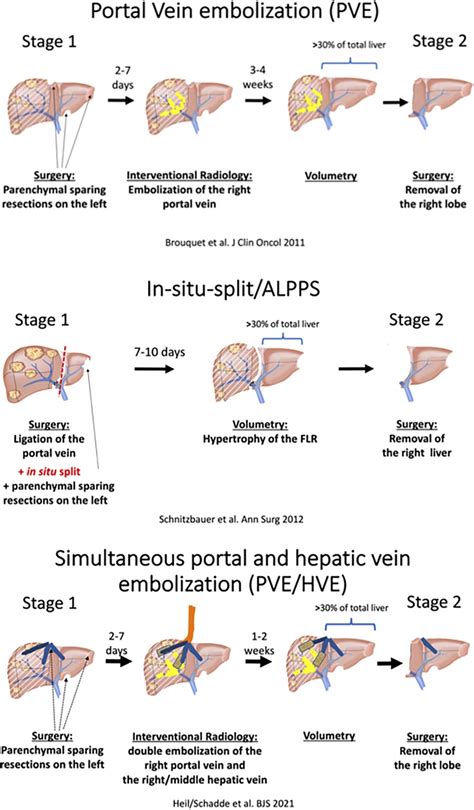 Frontiers Current Trends In Regenerative Liver Surgery Novel