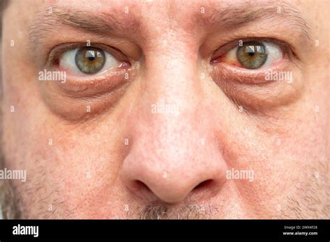 Redness Of The Eye Possible Consequences Of Capillary Rupture Or