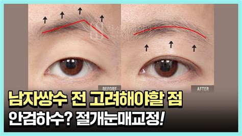 남자쌍수 전 고려해야할 점 안검하수절개눈매교정 Youtube