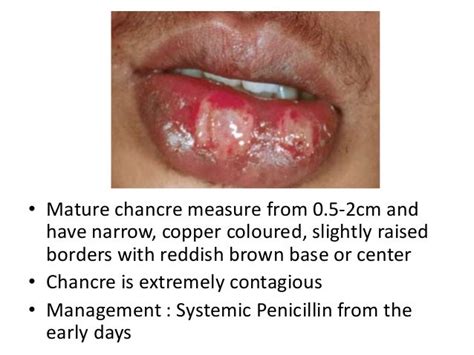 Solitary Oral Ulcers And Systemic Diseases