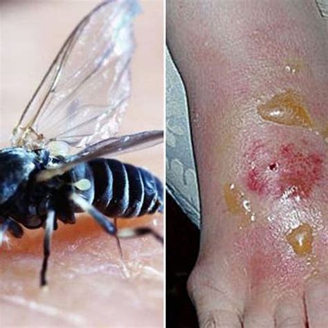 Robber Fly Bite Uk