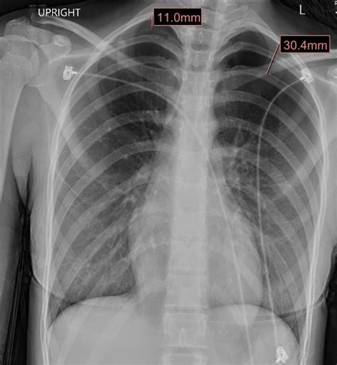 Ct Chest Showing Small To Moderate Pneumothorax At Admission Download Scientific Diagram
