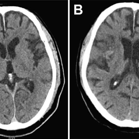 Radiological Outcome In Follow Up Imaging Ncct Indicates Non Contrast