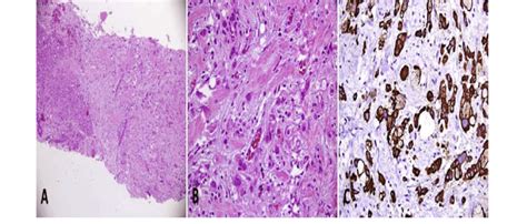 Metastatic Adenocarcinoma Favouring Primary Gall Bladder Origin