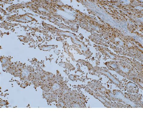 Figure 1 From Primary Malignant Neuroectodermal Tumor Of The Ileum With