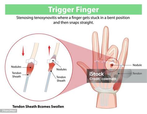 Diagram Explaining Trigger Finger Condition And Symptoms Stock Illustration Download Image Now