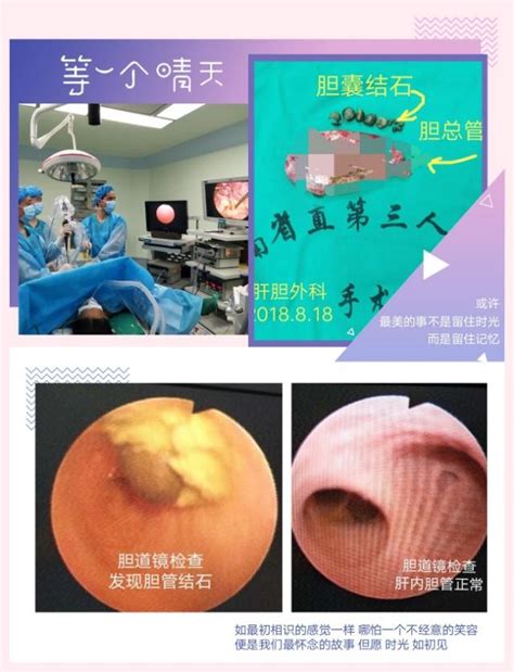 膽囊結石的話題（三） 每日頭條