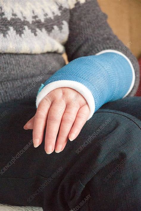 Broken Wrist Cast