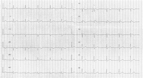 St Elevation Morphology Concave Down Vs Ppt Powerpoint Presentation