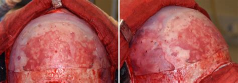 Plastic Surgery Case Study Custom Forehead Temporal Implant Replacement For Smaller PMMA