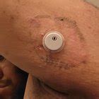 Longevity Of Libre Reader Device R Freestylelibre