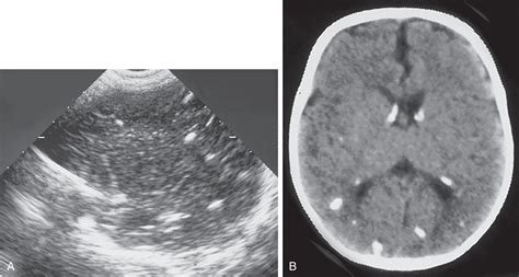 Viral Protozoan And Related Intracranial Infections Clinical Tree