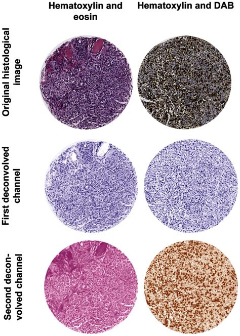 Using The Color Deconvolution Plugin An Image Of A Tissue Cores Double